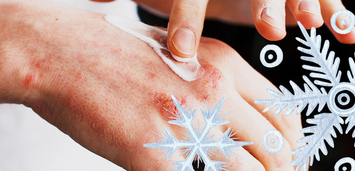 Atopický ekzém na podzim a v zimě: Proč se zhoršuje a co s tím ...